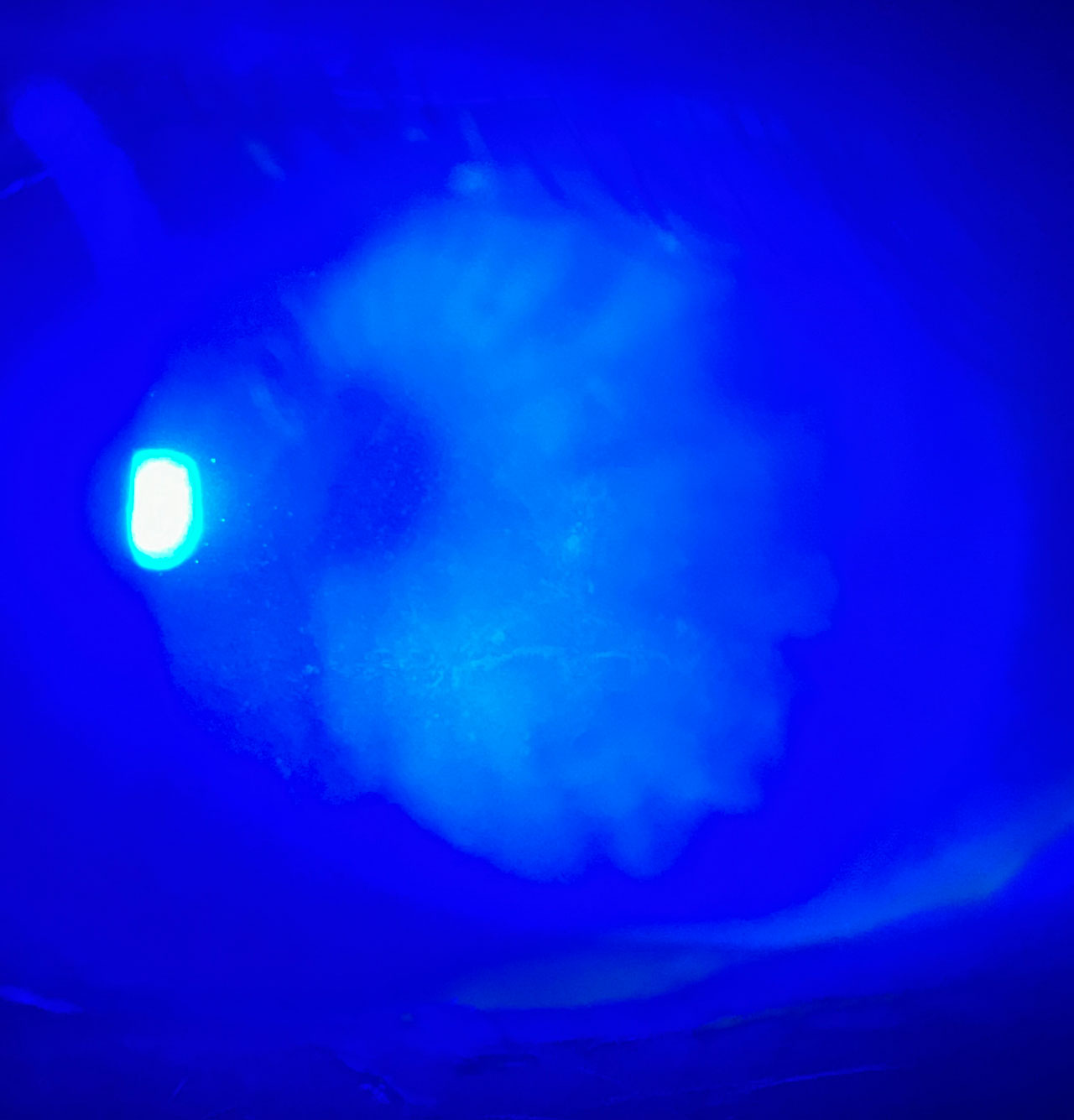 Dry Eye: Addressing Diabetic Keratopathy | Optometric Management